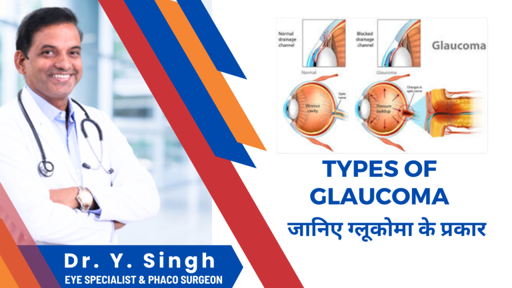 ग्लूकोमा के प्रकार (Types of Glaucoma)